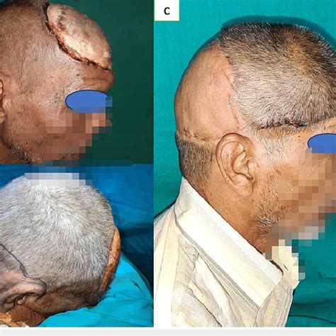A 14 X 14 Cm Sized Post Electric Burn Defect In The Frontoparietal