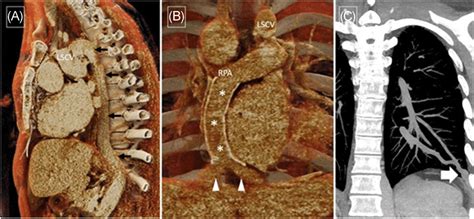 The Volume‐rendered Image A From A Patient With Left Isomerism Shows Download Scientific