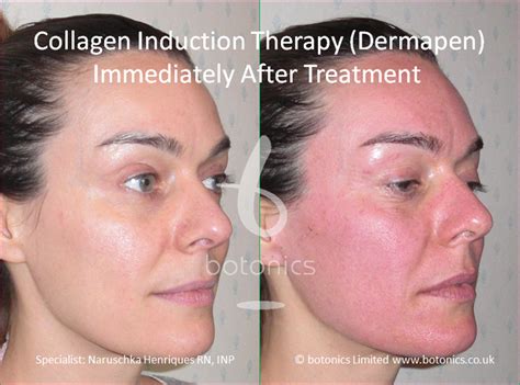 Dermapen And Dermaroller Before And After Photos Comparison In London Uk