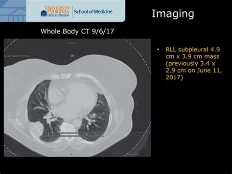 Squamous Cell Carcinoma From Institute Of Medicine Ppt