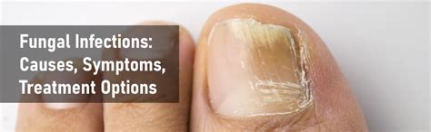 Fungal Infections Causes Symptoms And Treatment Options Okdermo