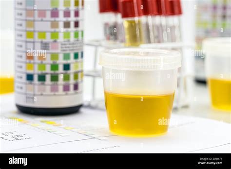 Bilirubin In Urine