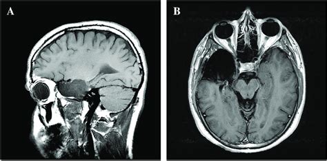 Follow Up Mri At 1 Year Post Resection A Sagittal T1 B Axial T1