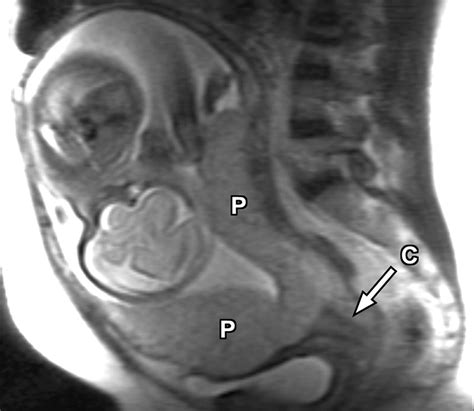 Imaging Of The Placenta A Multimodality Pictorial Review Radiographics