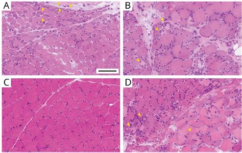 Figure 1 From Dermatomyositis Muscle Pathology According To Antibody