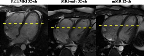 The First Of 25 Four Chamber View Images Acquired With A 2d Truefisp