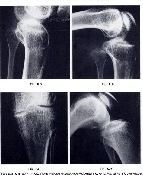 Figure 2 From Subluxation And Dislocation Of The Proximal Tibiofibular