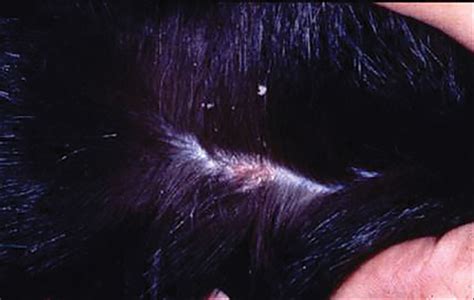 Dandruff Mites On Humans Toxoplasmosis My Xxx Hot Girl