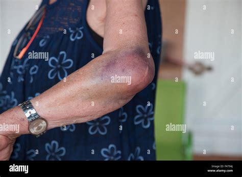 Hematoma Arm Hi Res Stock Photography And Images Alamy
