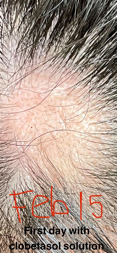 Clobetasol Propionate Topical Solution 005 Ralopeciaareata