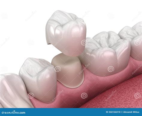 Preparated Premolar Tooth And Ceramic Crown Placement Medically