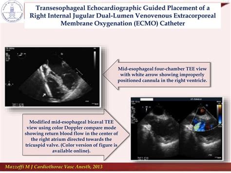 Cannulation And Recirculation In Vv Ecmo