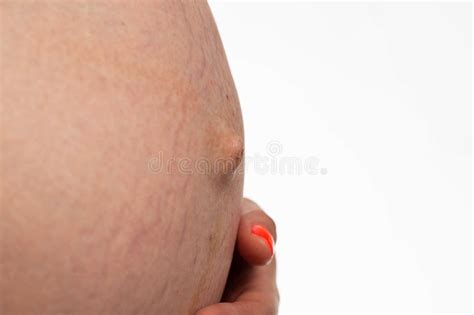 Stretch Marks On The Abdomen Of A Pregnant Girl A Bulging Navel