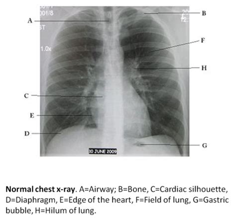 Chest X Ray Flashcards Quizlet