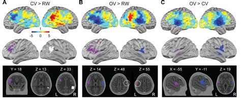 Figure 6 From Mapping Cortical Activations Underlying Covert And Overt Language Production Using