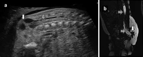 Case 10 A Us Image Csb Diagnosed As Terminal Myelocystocele Because Of