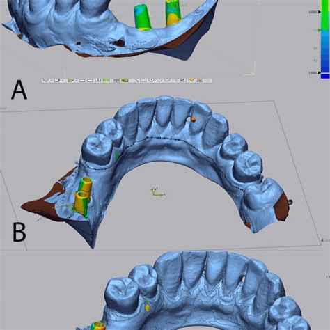 Conventional Implant Impression Techniques A Closed Tray Impression