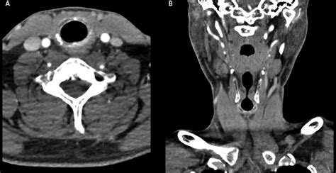 Axial A And Coronal B Images From Extracranial CT Angiography