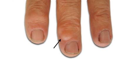 Mucous Cyst Of The Finger Hand Surgeryeu