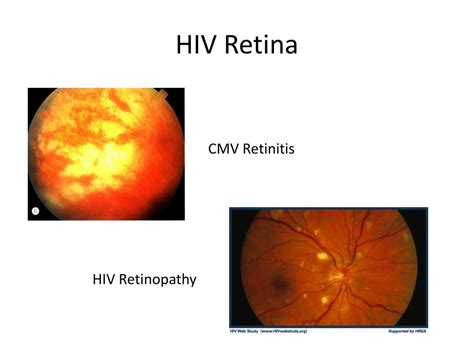 Ppt Hiv And The Eye Powerpoint Presentation Free Download Id1870521