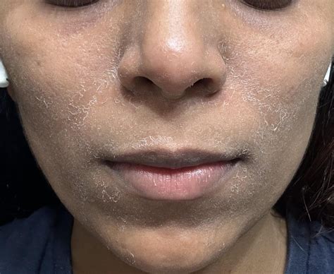 Tret Purging Or Cold Weather Issue R30plusskincare
