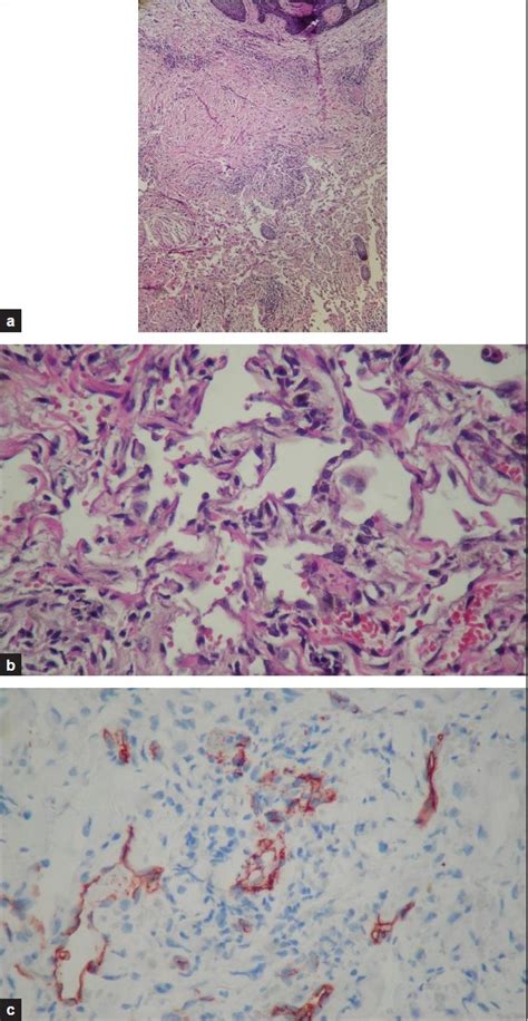 Angiosarcoma Of The Trunk Of Unusual Presentation In An Immuno