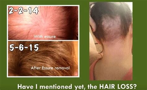 Pin On Essure Side Effects