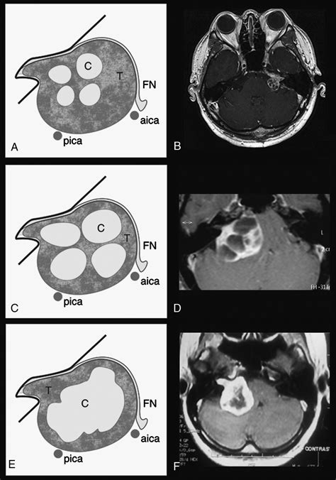 Cystic Vestibular Schwannoma Classification Management An