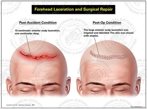 EMS SOLUTIONS INTERNATIONAL By DrRamonReyesMD Marca Registrada Scalp Laceration Can Cause Of