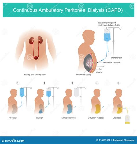 Osmosis In Peritoneal Dialysis