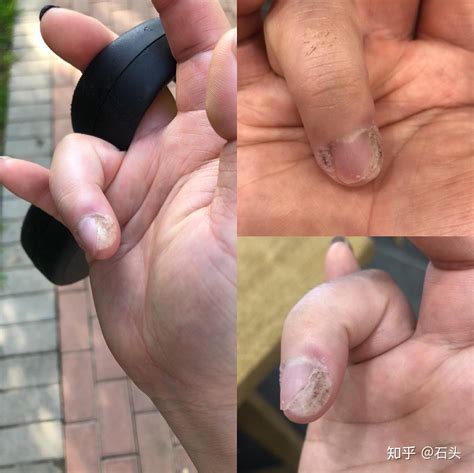 甲周疣 知乎