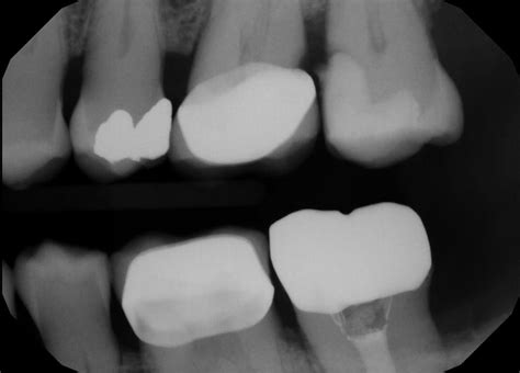 Best Practices For Class Ii Restorations Innovative Thermoviscous Bulk