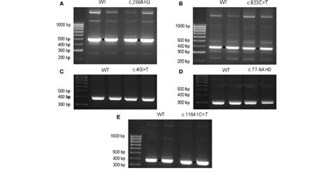 Results Of Minigene Splicing Assay For The Five Bbsalms1 Putative