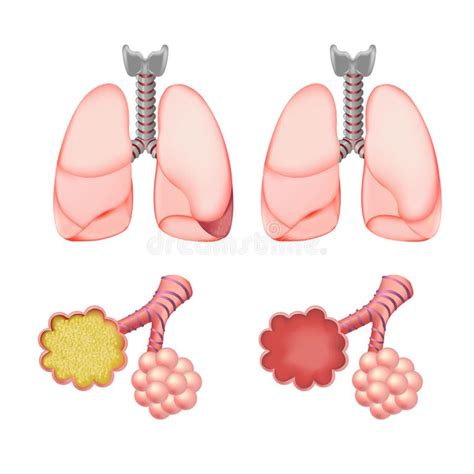 Bronchiole Alveoli Stock Illustrations 218 Bronchiole Alveoli Stock