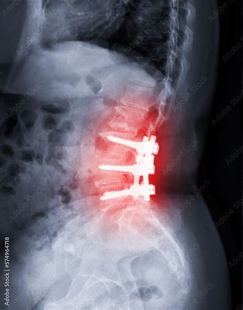 X Ray Image Of Lumbar Spine Showing Pedicle Screw Fixation And
