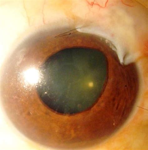 One Week After Surgery The Bleb Is Diffuse Conjuctival Vessels Have