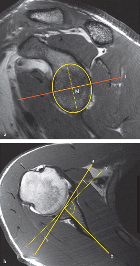 Acromion Types