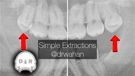 Simple Tooth Extractions Drwahan Youtube