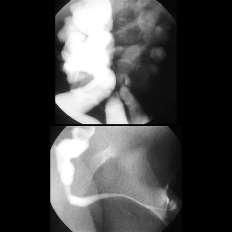 Posterior Urethral Valves Pediatric Radiology Reference Article