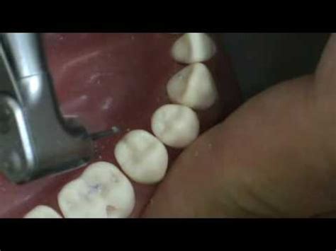 Class Cavity Mandibular First Premolar YouTube