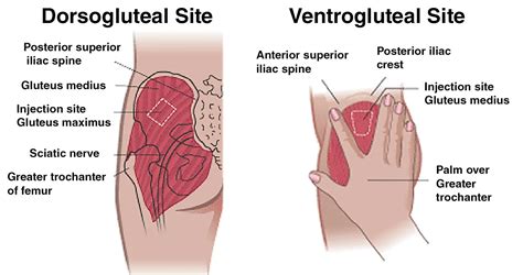 Understanding The Ventrogluteal Injection Technique E Phlebotomy Training