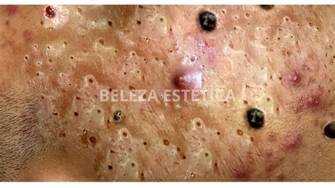 Como Remover Cravos E Espinhas Do Rosto Agulha 001 YouTube