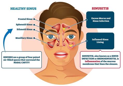 Natural Remedies For Sinus Infection Relief That Work