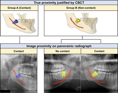 Automatic Diagnosis Of True Proximity Between The Mandibular Canal And