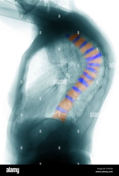 Compression Fracture