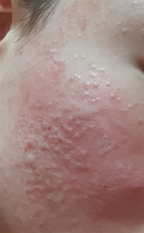 아토피 습진 피부에 하얗게 뭐가 올라왔는데 왜 이런가요ㅠㅠ 지식in