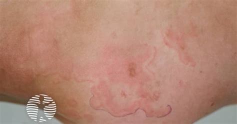 Erythema Marginatum Image