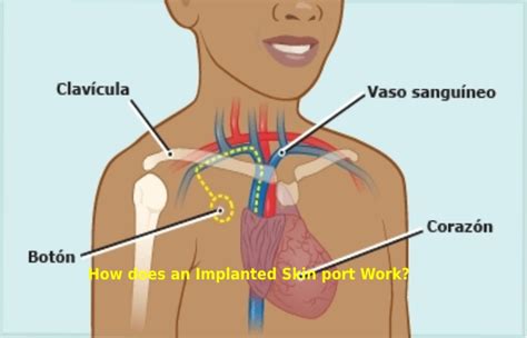 Information About The Implanted Skin Port