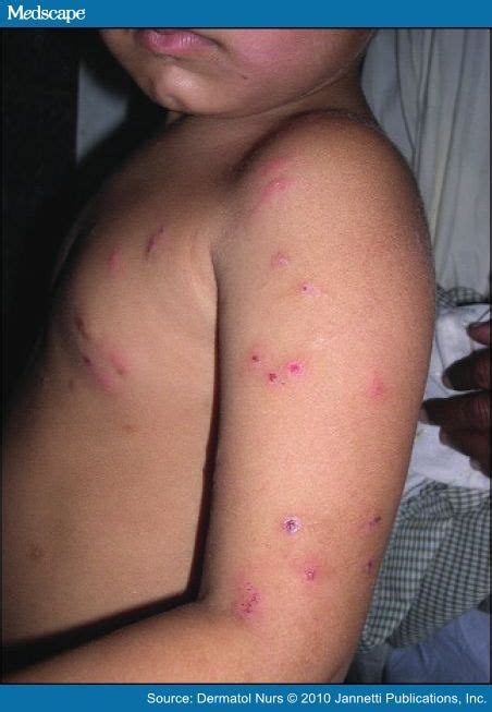 Erythematous Papular Rash