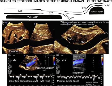 Venous Duplex Ultrasound Protocol For Iliocaval Disease Journal Of